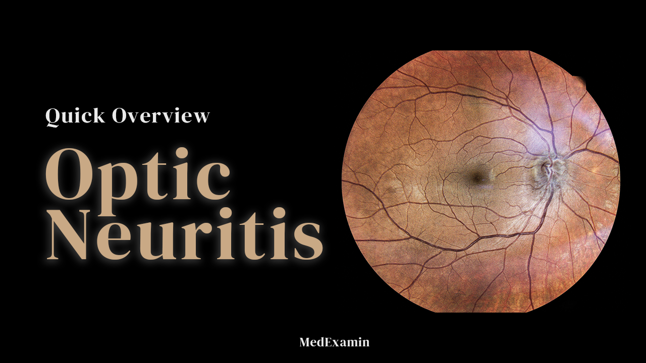 Optic Neuritis: Review easily through Flashcards – MedExamin