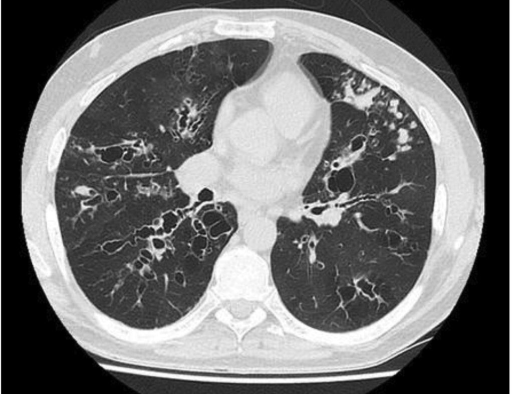 Bronchiectasis: Everything you need to know! – MedExamin