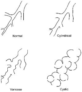 Bronchiectasis: Everything you need to know! – MedExamin