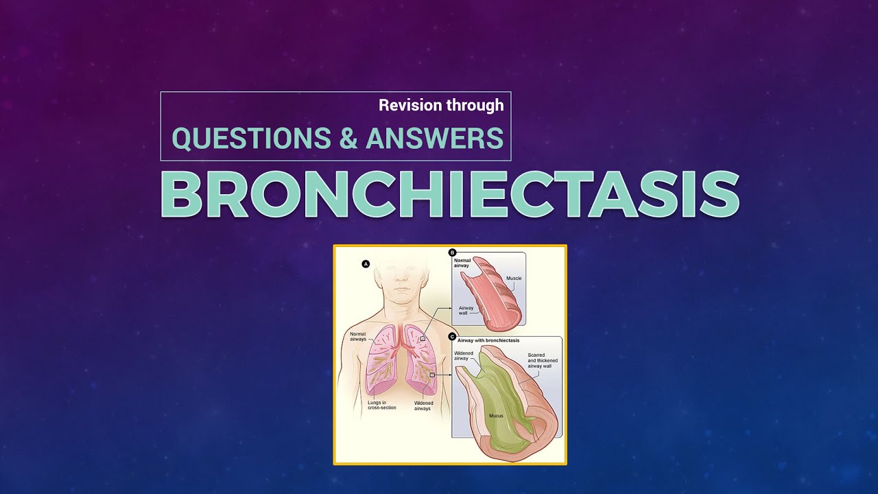 Bronchiectasis: Everything you need to know! – MedExamin