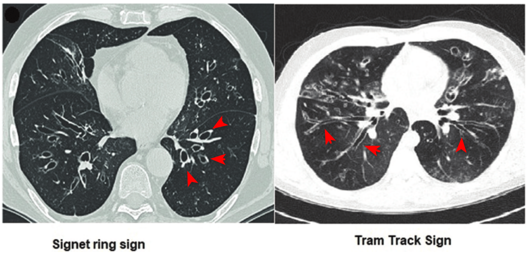 Bronchiectasis: Everything you need to know! – MedExamin